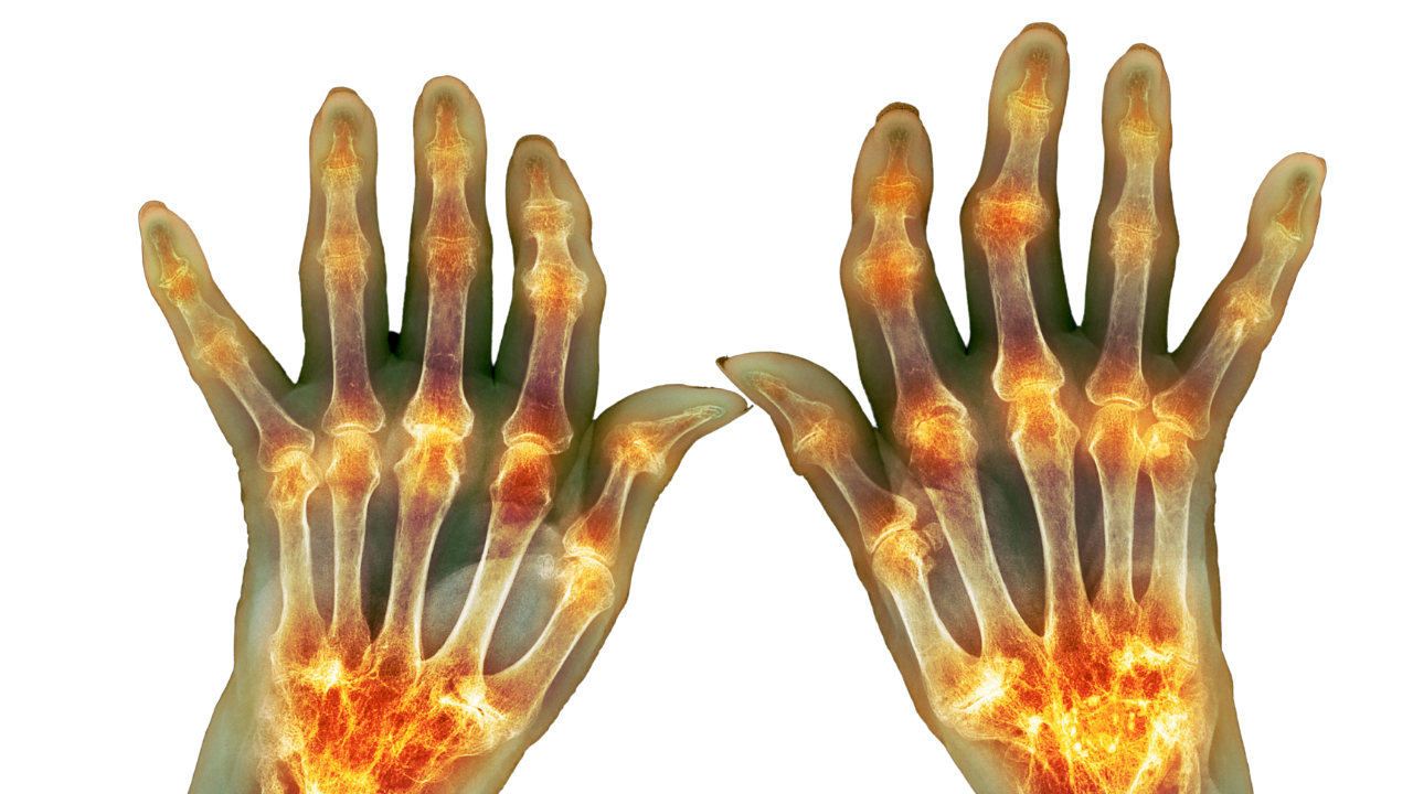 Rheumatoid Arthritis: An autoimmune disorder causing joint inflammation ...