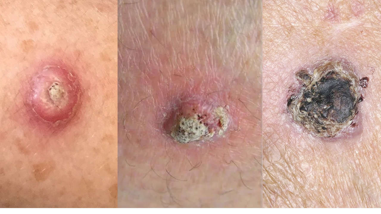 Squamous Cell Carcinoma: A type of skin cancer. - Genes Cure